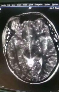 Young Woman's Body & Brain Riddled With Parasitic Worms & Cysts - After ...