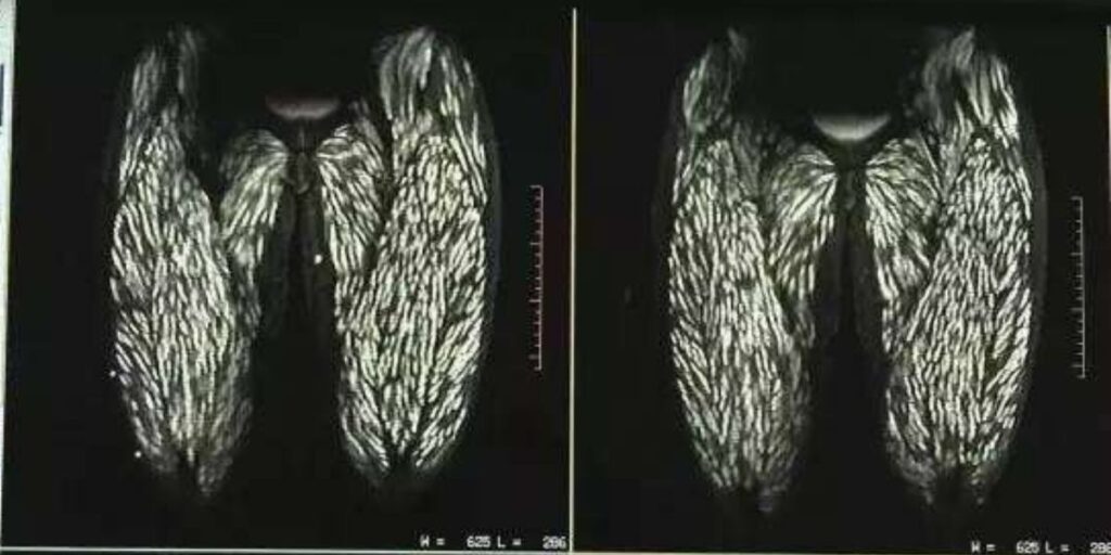 Young Woman's Body & Brain Riddled With Parasitic Worms & Cysts - After ...